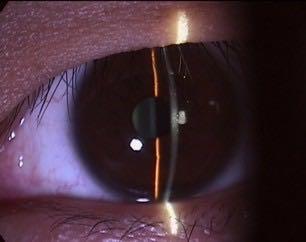 裂隙灯的检查方法及内容 - 知乎