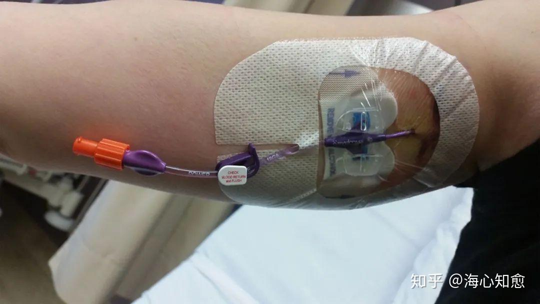 输液港与PICC哪个更好？ - 知乎