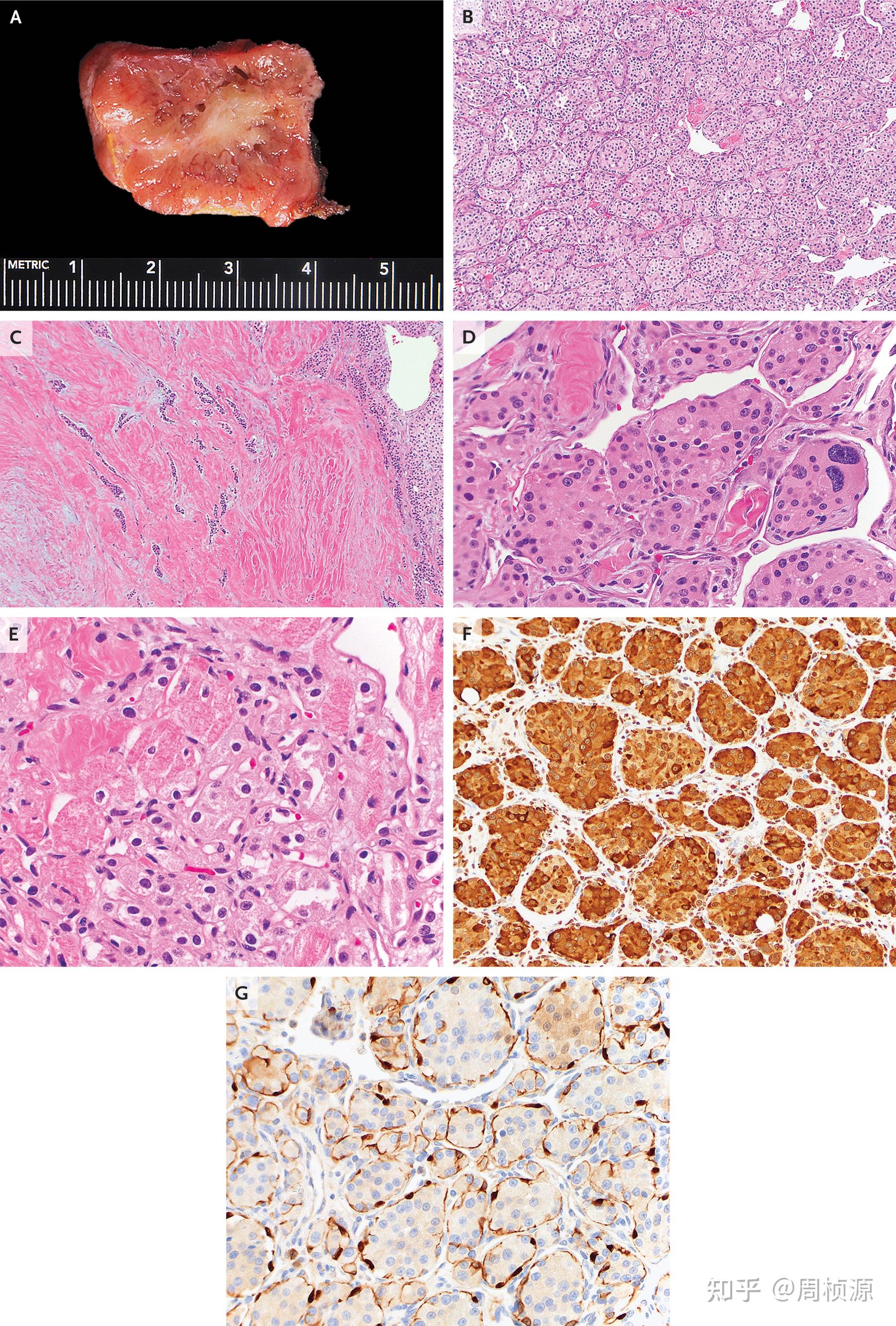 Nejm 2022 Case 40 - 知乎