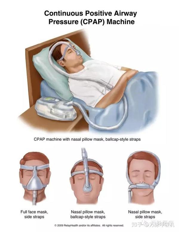 睡眠杀手 阻塞性睡眠呼吸暂停综合征 知乎