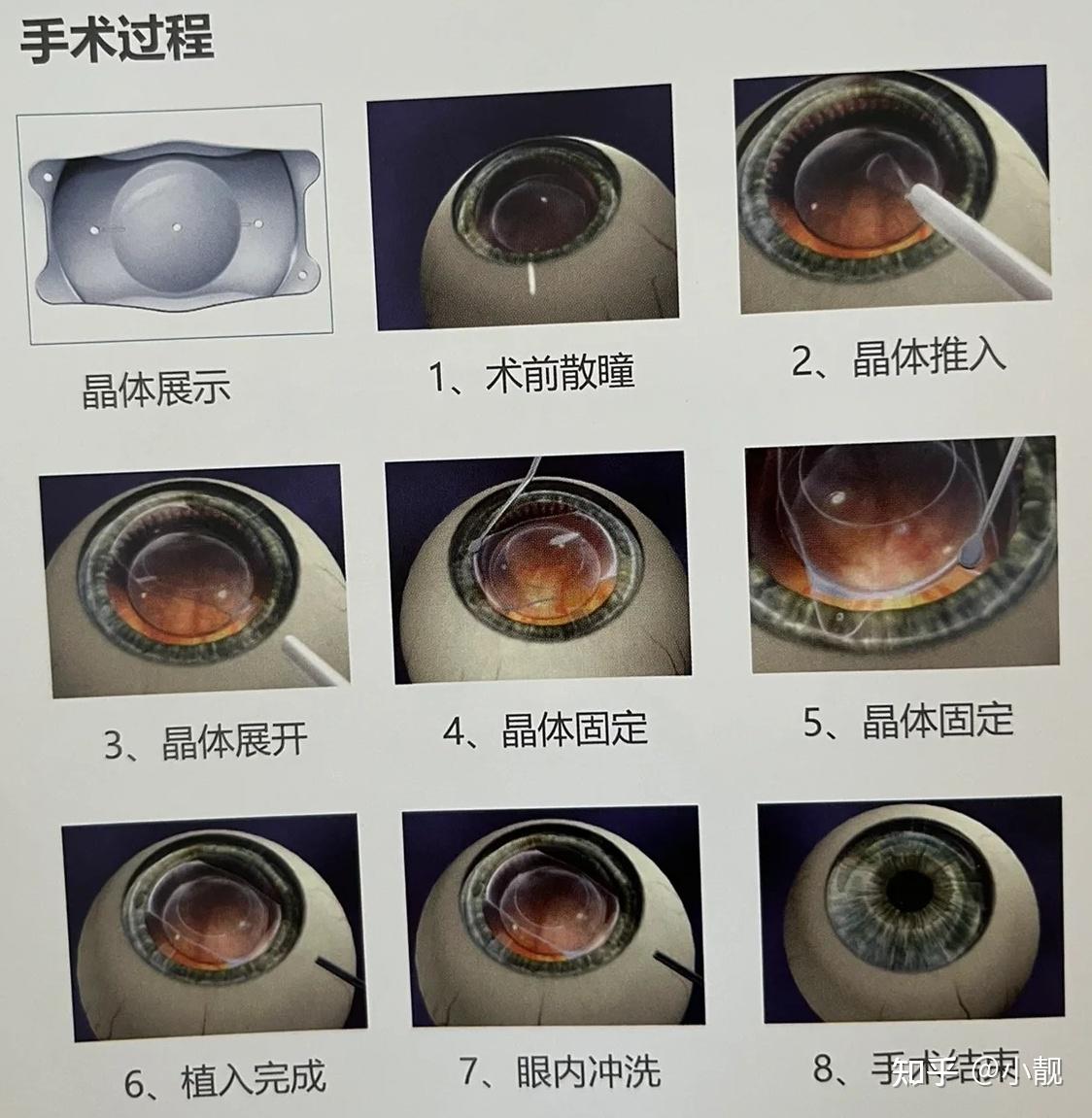 晶体植入ICL - 知乎