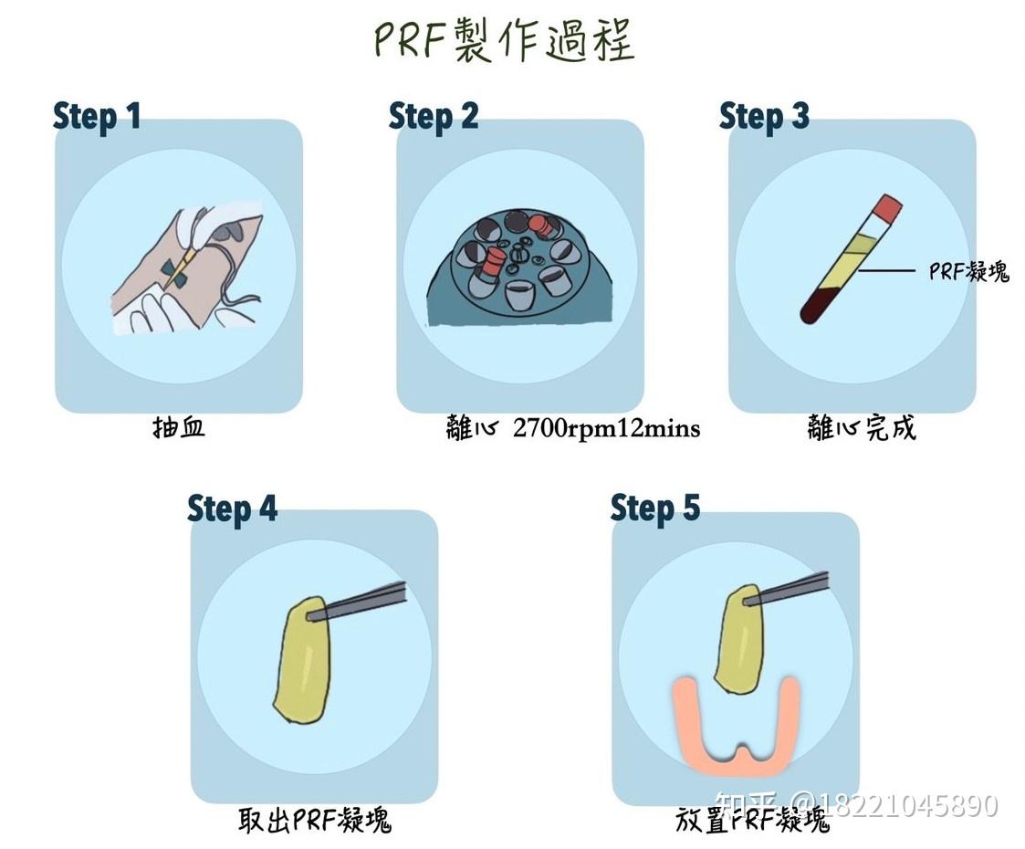 淺談PRF與牙科 - 知乎