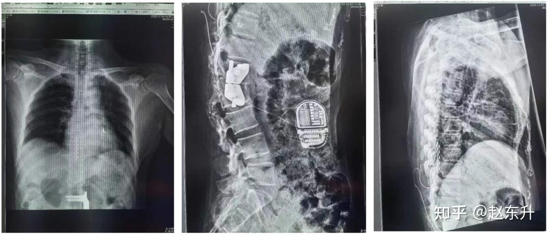 SCS脊髓电刺激疗法DTM™程控模式治疗25年右下肢顽固性疼痛 - 知乎