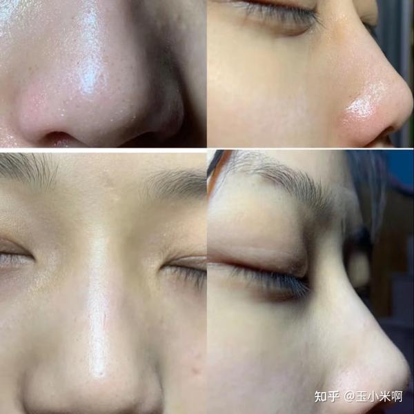 为什么各种方法都试过了,黑头还是反反复复,有什么克黑头反复、毛孔大,真有用的那种!!! 知乎