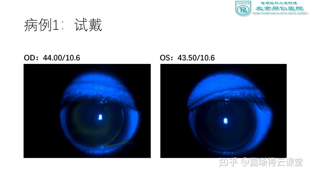 角膜地形图解读及露晰得塑形镜验配要点（文字版） - 知乎