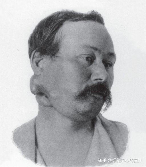 免疫百年 | 绝望中开出的希望花朵：癌症免疫学之父William Coley - 知乎