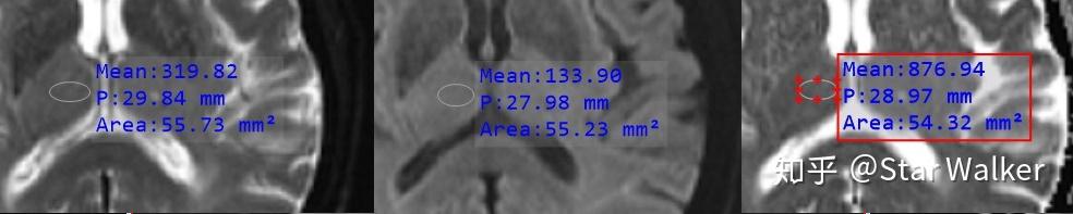 MRI ADC值是怎么来的？咱们来手算一下 - 知乎