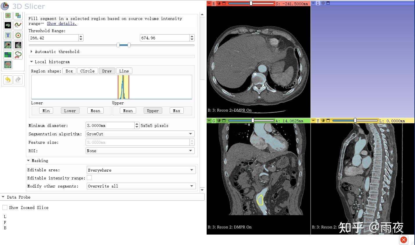 3D slicer 重建腹主动脉及髂动脉 - 知乎