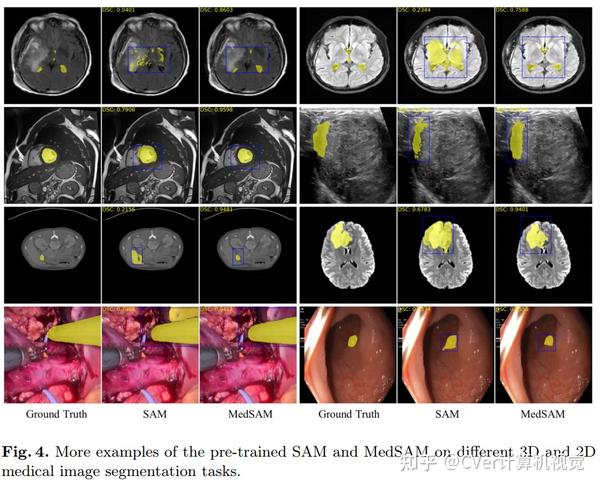 MedSAM：分割医学图像中的一切 - 知乎
