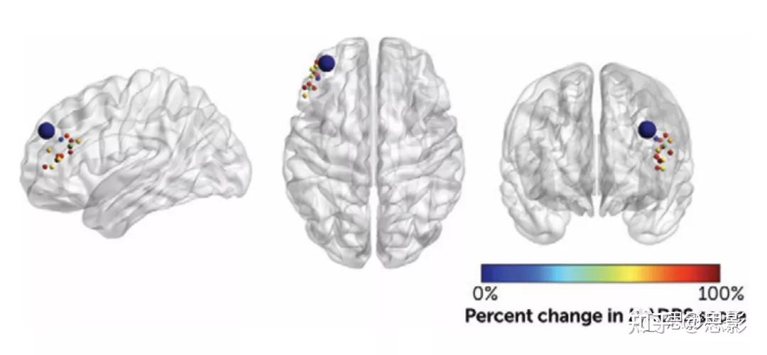 斯坦福神经调控疗法(Stanford Neuromodulation Therapy, SNT) - 知乎