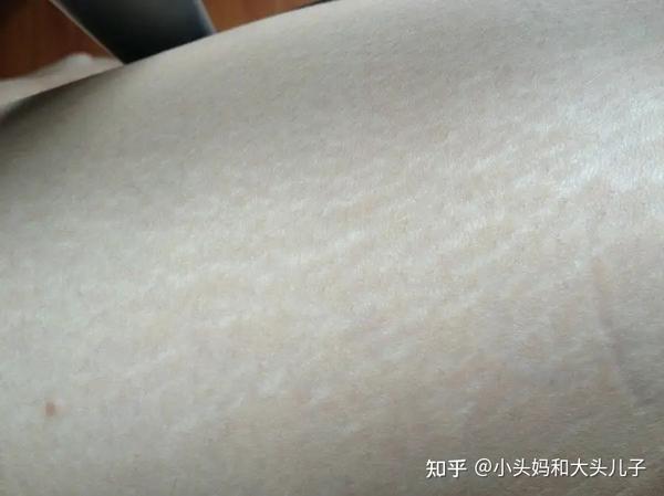 年轻人的心头大患【肥胖纹】应如何淡化?瘦了之后肥胖纹能完全消除吗?历经一年多终于淡化肥胖纹,这3个冷知识真的能淡化肥胖纹!