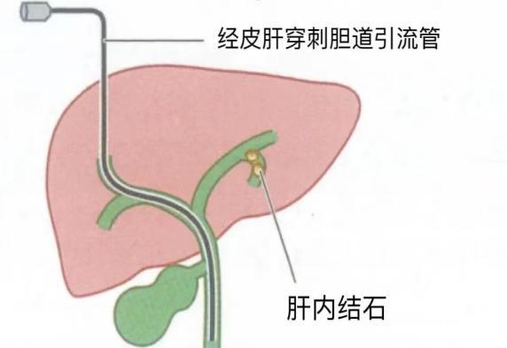 健康科普 | 给患者的一封信— PTCD管居家护理，您get 了吗？ - 知乎