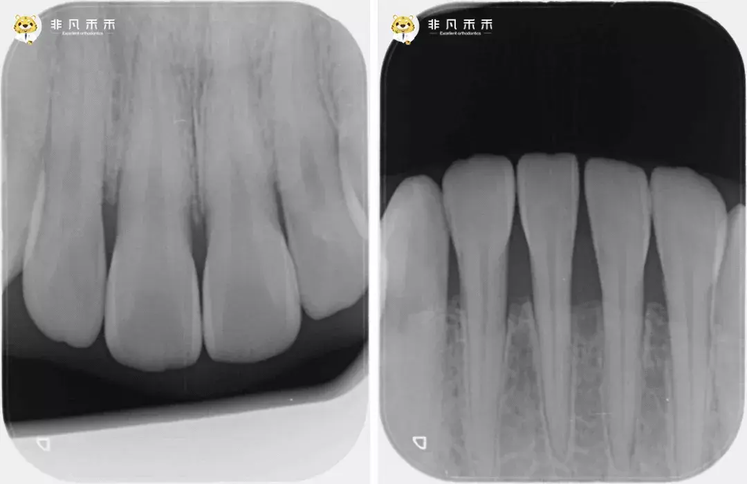 『正畸病例』嘴突，地包天，反𬌗病例 1 例 - 知乎