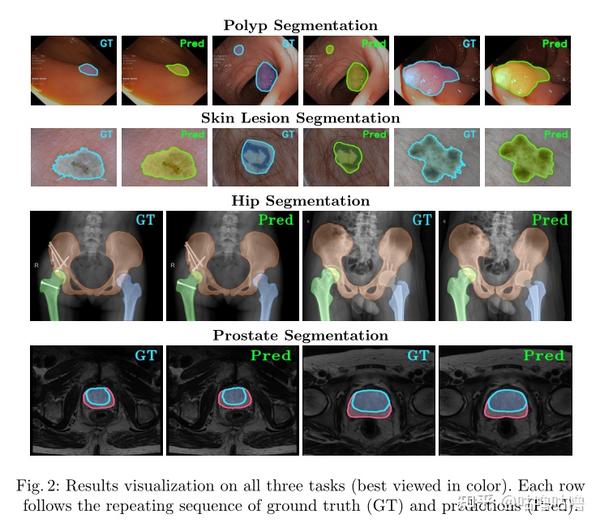 学习 TransFuse: Fusing Transformers and CNNs for Medical Image ...
