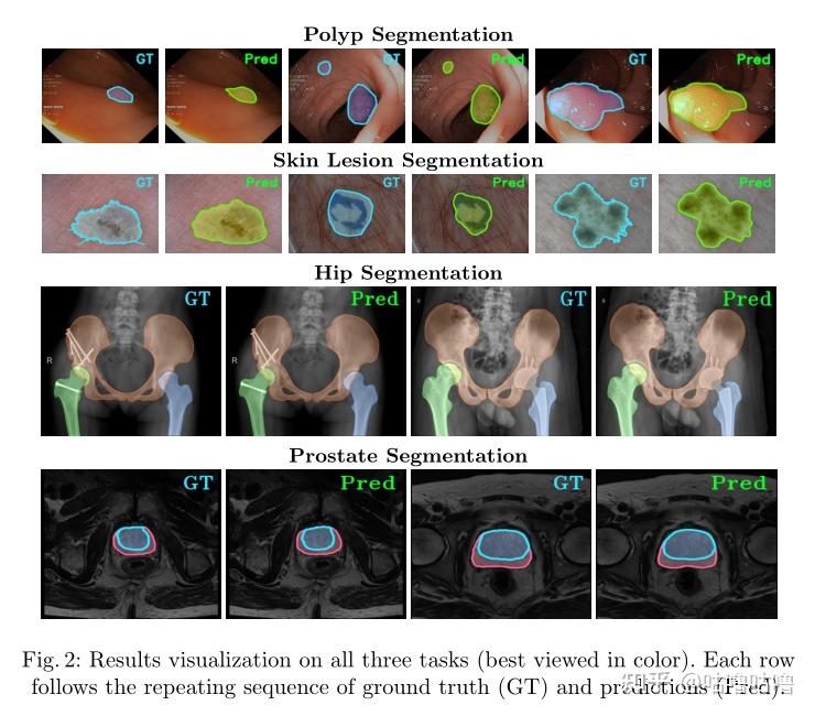 学习 TransFuse: Fusing Transformers and CNNs for Medical Image ...