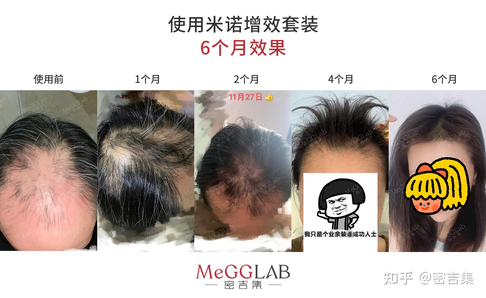 密吉集米诺地尔增效剂（头皮辅酶精华液）minoxiboost竟是国际大阴谋？ - 知乎
