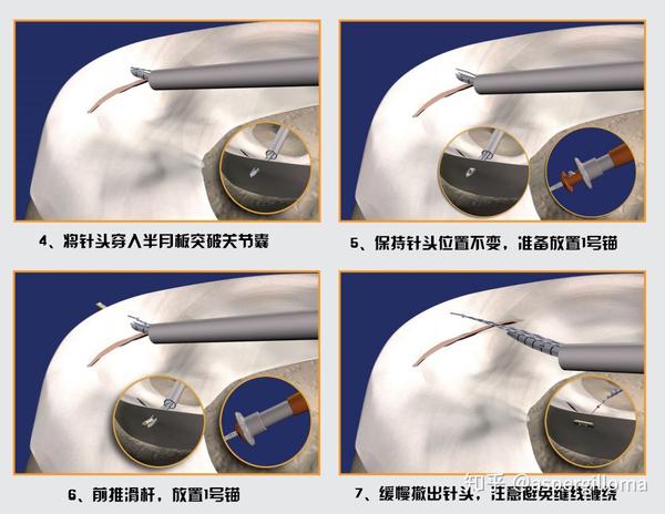 半月板缝合全内(All-inside)技术解读 - 知乎