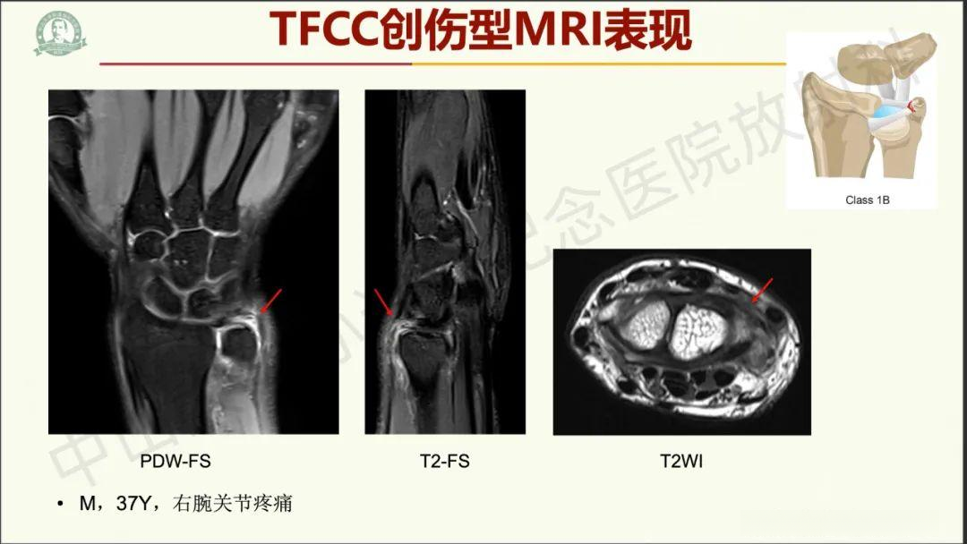 TFCC损伤MRI诊断 - 知乎