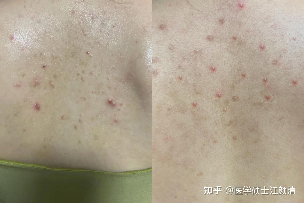 背部痘痘太丑了,如何才能真正的祛除背部痘痘?医学硕士教你正确去除背部痘痘的方法!后背痘还得靠这4步! 知乎