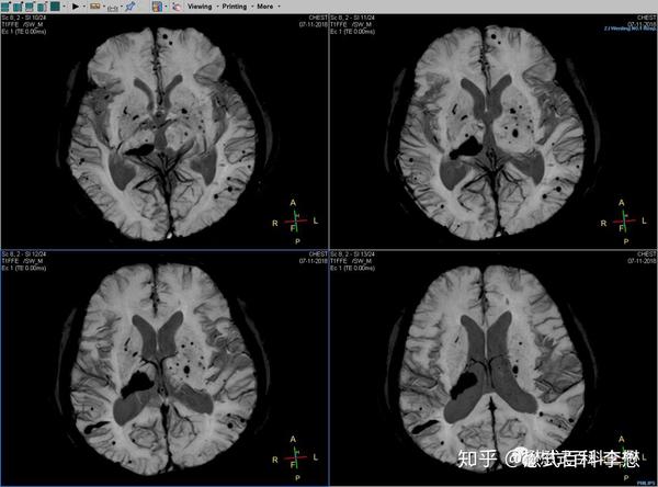 SWI序列原理及临床应用 - 知乎