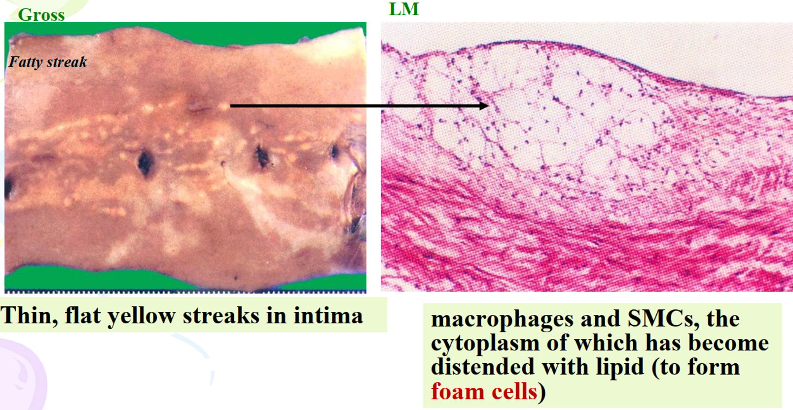 循环病理学：动脉粥样硬化系列疾病 - 知乎