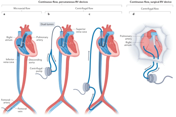 机械循环辅助装置进展及应用 - 知乎