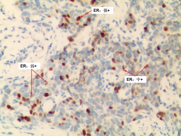 病理规培：一文掌握乳腺癌ER、PR免疫组化判读 - 知乎