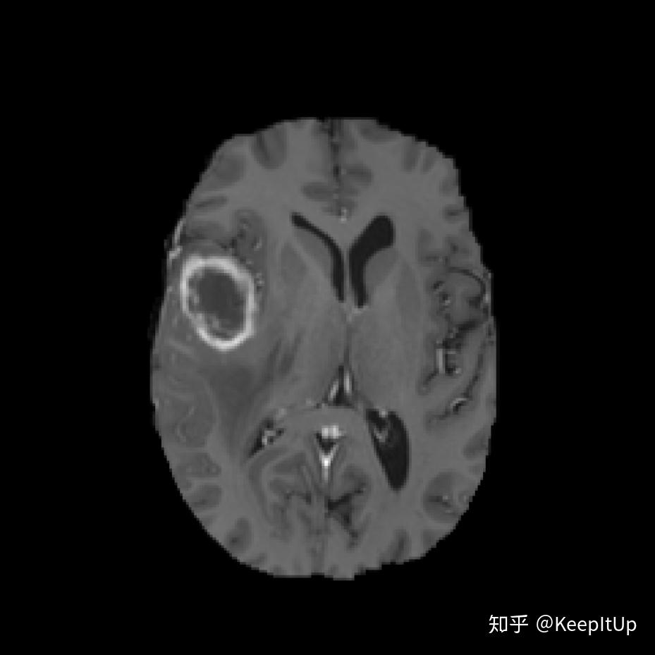 医学影像分割入门、MRI、t1、t2等序列概念 - 知乎