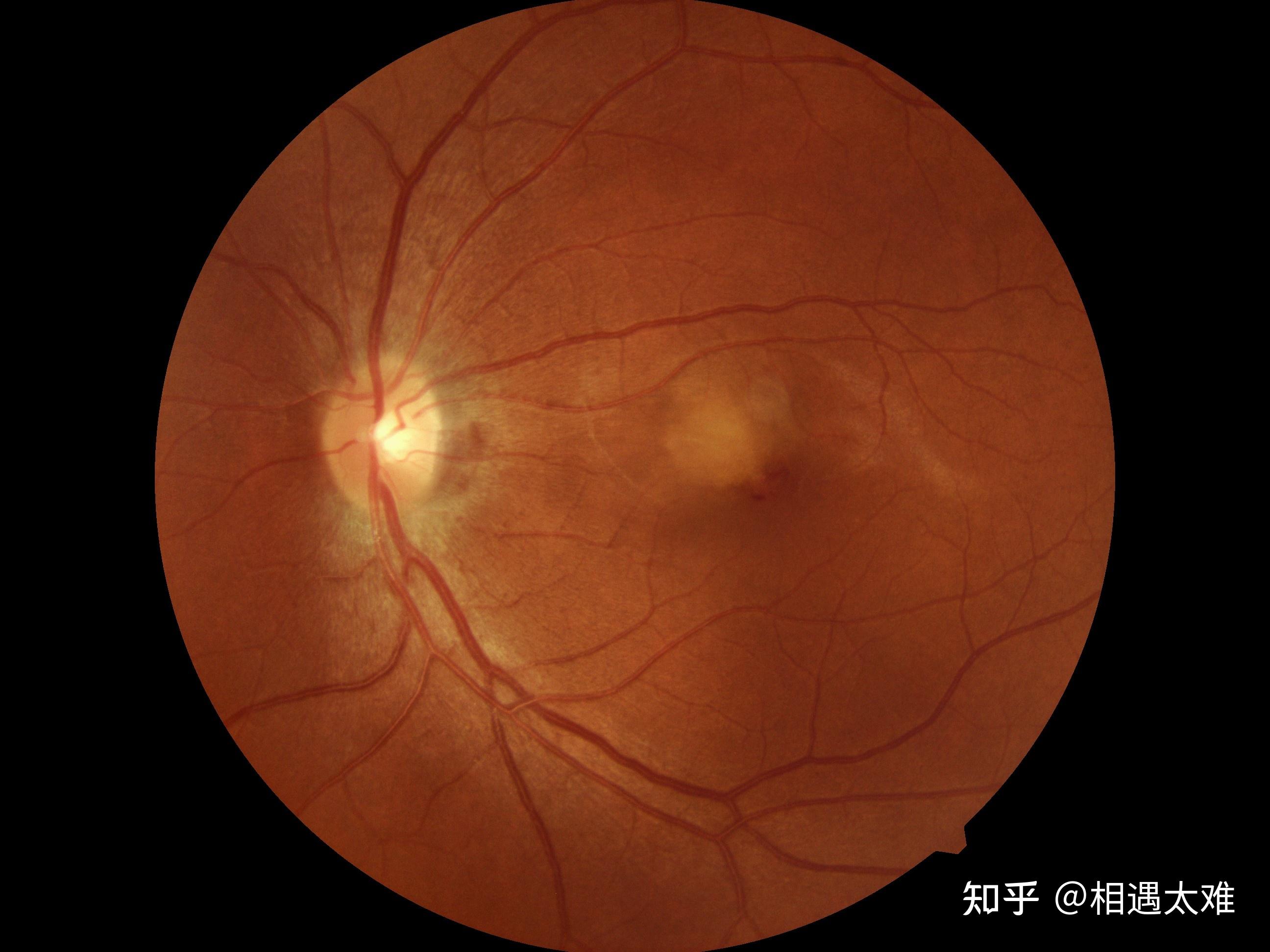 眼底黄斑病变 知乎