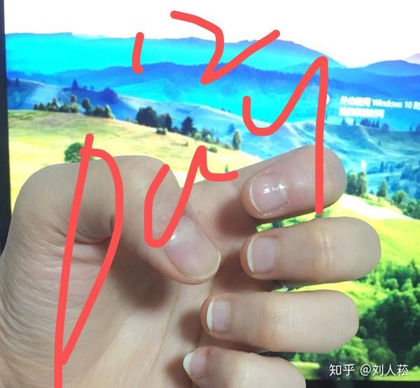 如何戒掉咬指甲?和23年咬指甲的过去说再见的全记录~ 知乎