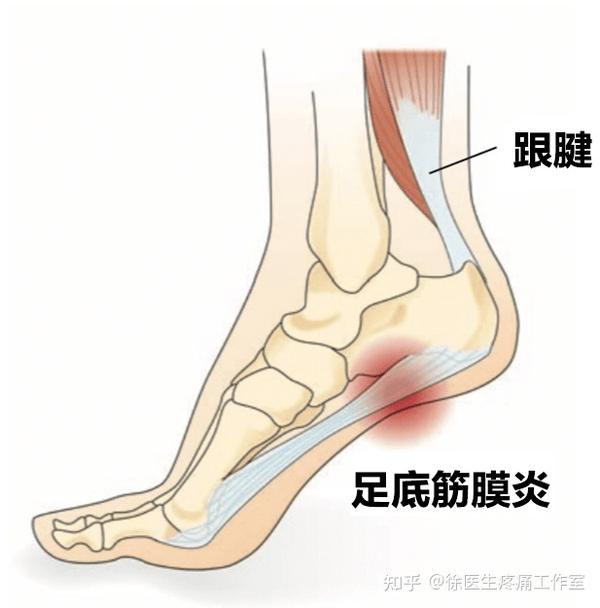 放任足底筋膜炎容易长骨刺！一条毛巾练脚趾改善筋膜柔软度！ 知乎