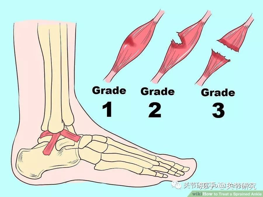 踝关节扭伤的自我处理 - 知乎