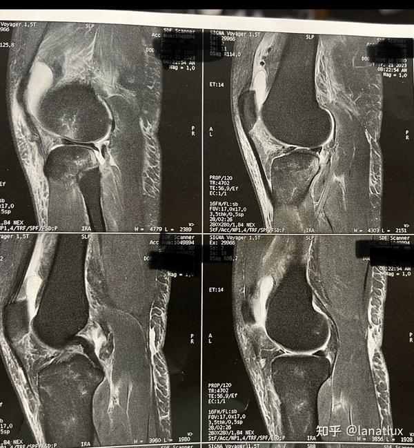 海外版# 前交叉韧带ACL ，内副韧带MCL加后斜韧带POL重建合并半月板损伤（一）之术前康复加手术 - 知乎