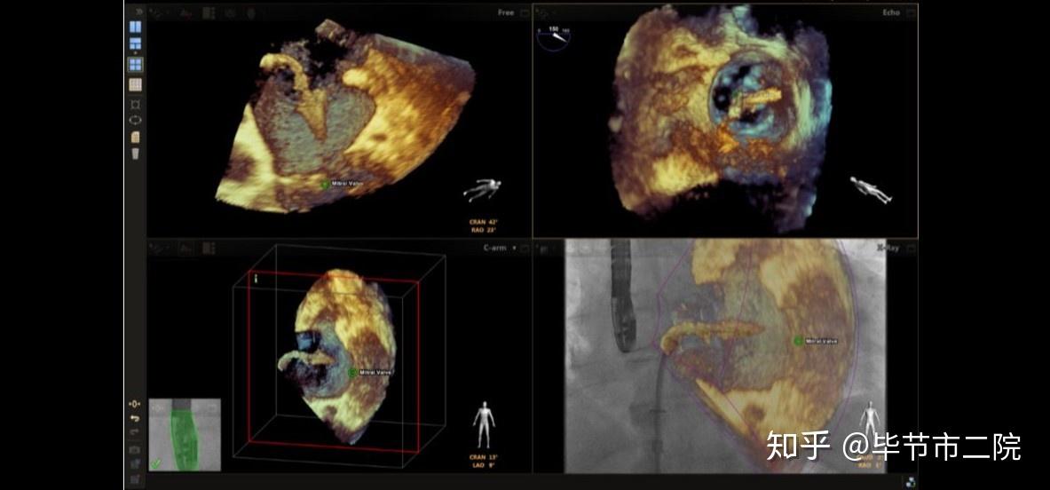 我院引进荷兰飞利浦DSA血管造影系统，技术设备再上新台阶！ - 知乎