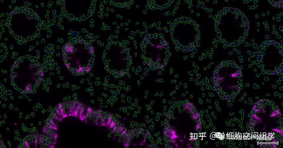 多色免疫荧光TMA样本案例分析 - 知乎