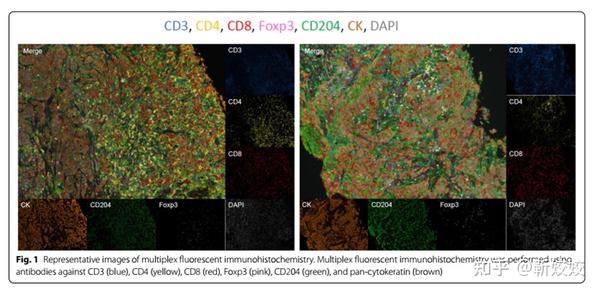 经典案例合集 | 多重免疫荧光在乳腺癌研究中的应用，从这几个角度入手！ - 知乎