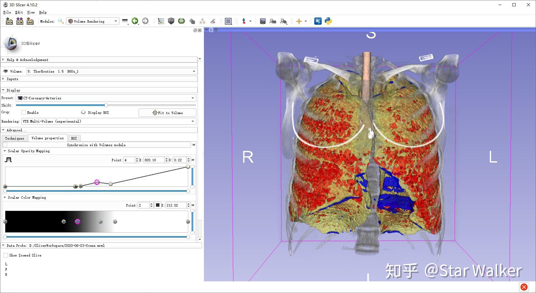 用3D Slicer来实现肺部密度分析可视化 - 知乎