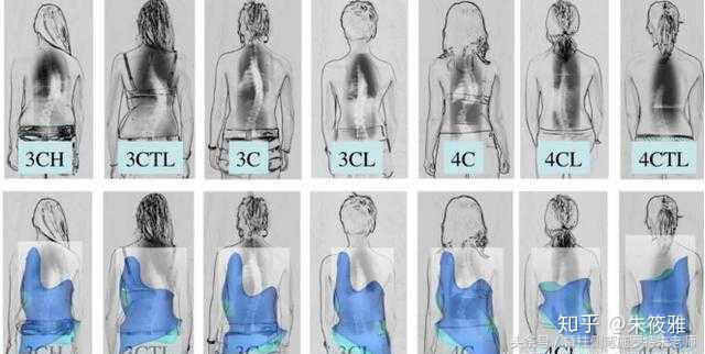 日常生活与脊柱侧弯之间的关系？ - 知乎