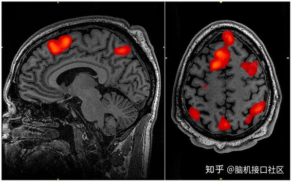 EEG vs MRI vs fMRI vs fNIRS简介 - 知乎