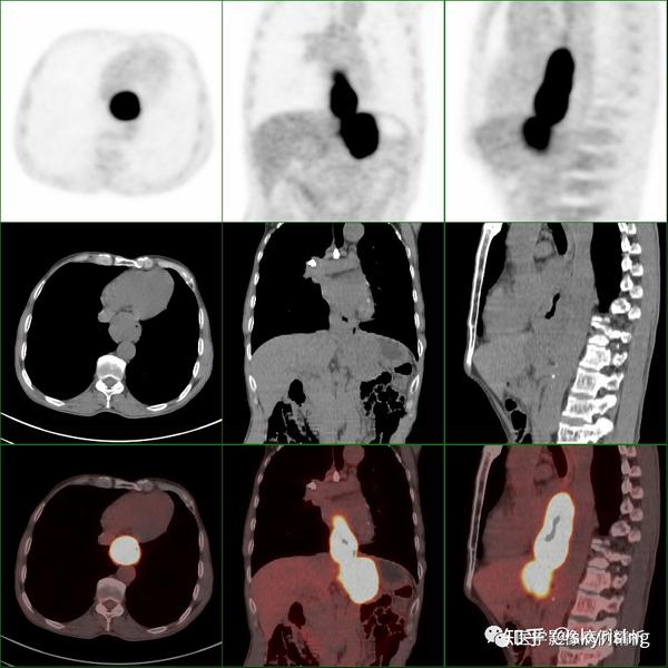 一文通读解析PET-CT检查所有注意事项、放射性危害及典型教学病例一例 - 知乎