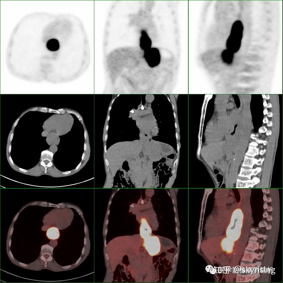 一文通读解析PET-CT检查所有注意事项、放射性危害及典型教学病例一例 - 知乎