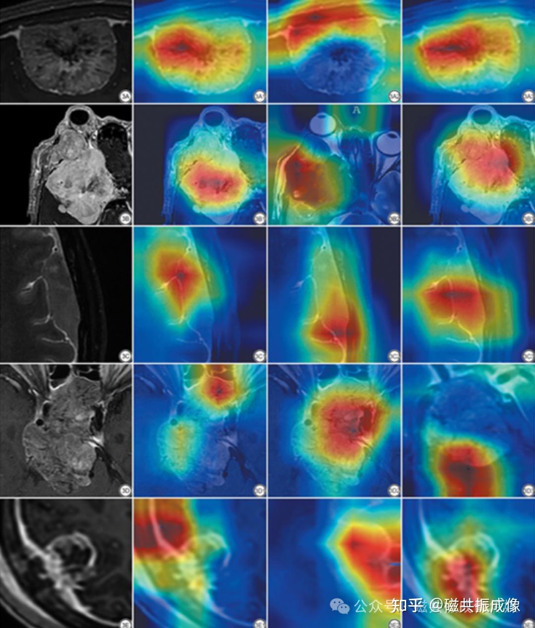 基于多序列MRI的2.5D卷积神经网络鉴别脑膜瘤的多中心研究 - 知乎