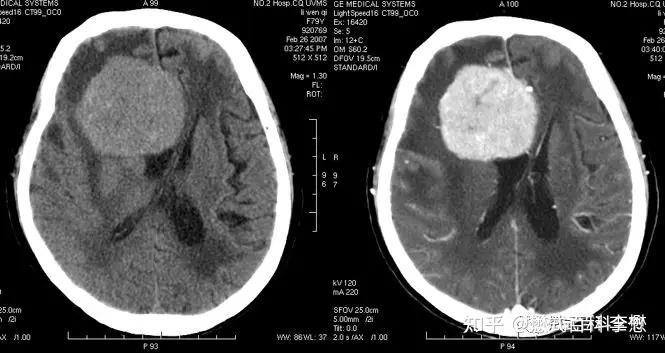 碘对比剂的相关特性及临床应用 - 知乎