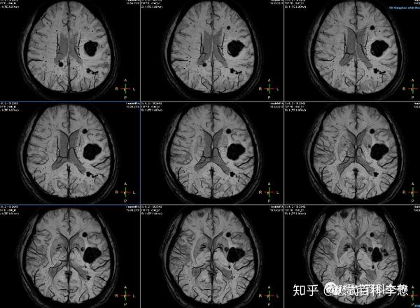 SWI序列原理及临床应用 - 知乎