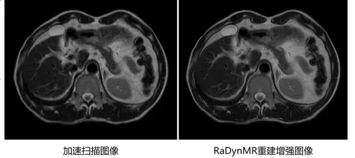 RaDynMR加速腹部肝脏MRI扫描 - 知乎