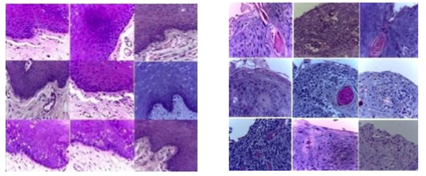 OSCC 口腔鳞状细胞癌病理图像分类数据集介绍 - 知乎