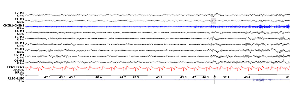 正常睡眠的分期和结构 - 知乎