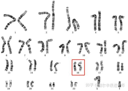 1分钟带您了解16号染色体常见疾病及多态 - 知乎
