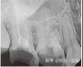 美亚口腔CBCT，让MB2无所遁形！ - 知乎