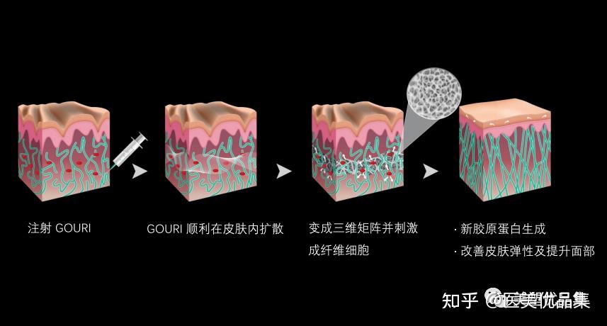 第四代童颜针GOURI——全球首创液态型PCL - 知乎